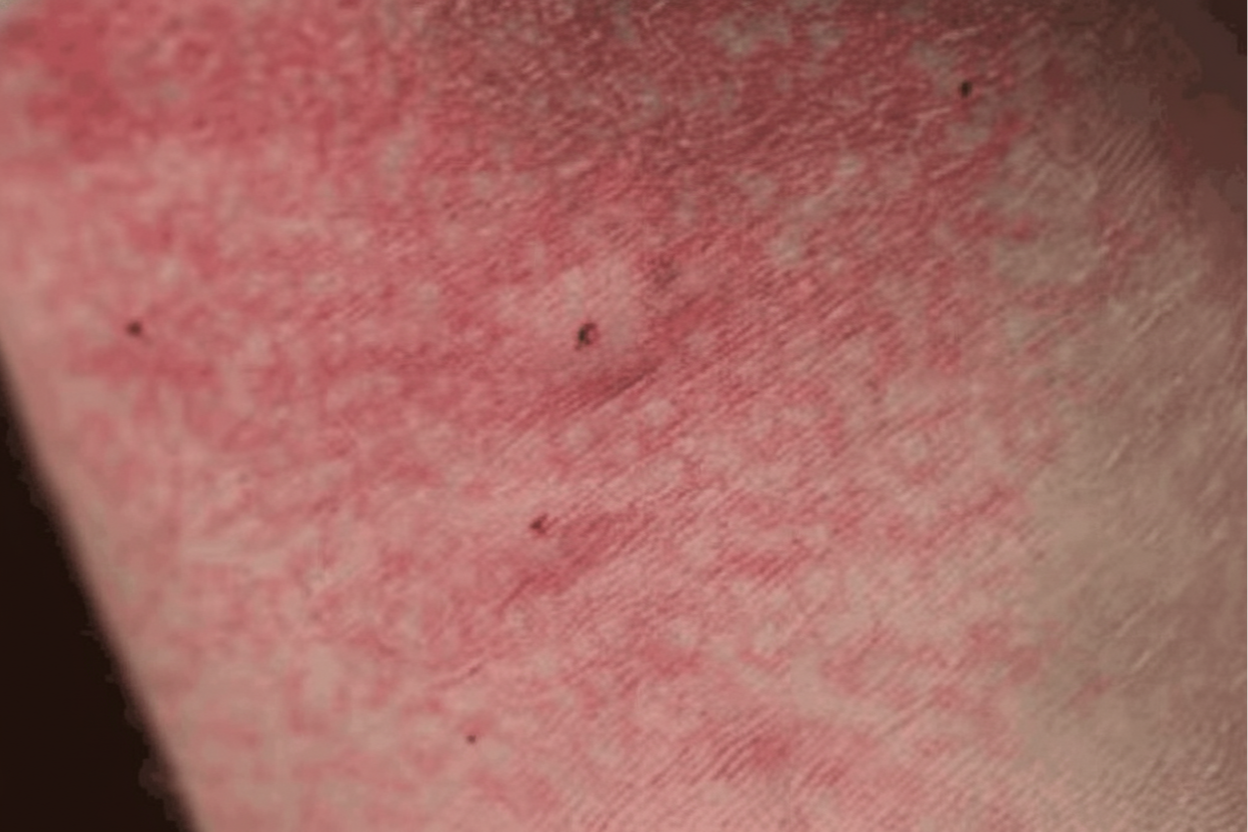 #1 Powerful Spider bites Guide for Safe, Calm Care